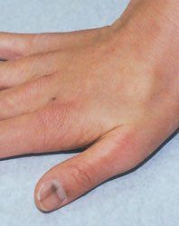 Brown Band on Teenager's Thumb: What Cause?