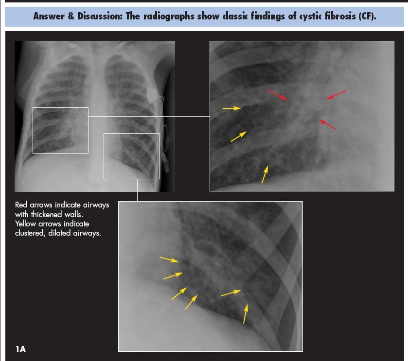 Cystic Fibrosis Classic Radiographic Findings