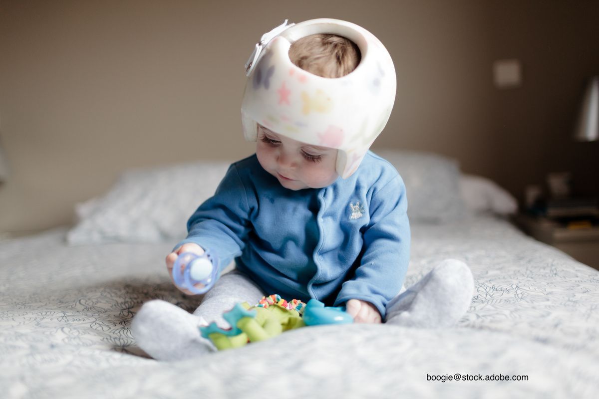 Misshapen heads in infants create complicated assessment