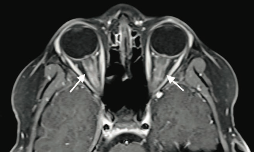Bilateral blurry vision in a 9-year-old boy