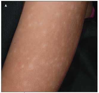 Are These New Erythematous Papules Related to the Patient's ...