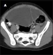 Omental Cyst Presenting as Acute Abdomen