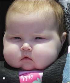 Infant With All-Over Rash, Edema, and Lethargy