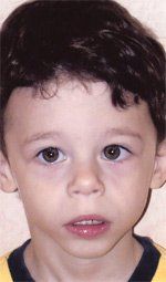 Toddler With Elfin Face, Cardiovascular Abnormalities, Hypercalcemia ...