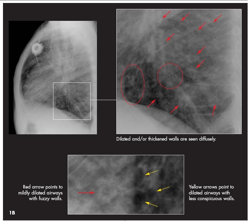 Cystic Fibrosis Classic Radiographic Findings