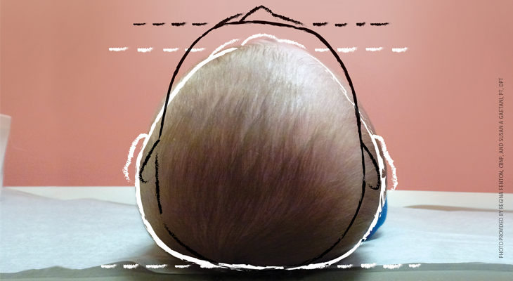 A pediatric epidemic: Deformational plagiocephaly/brachycephaly and ...