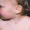 Branchial Cleft Cyst in an Infant | Contemporary Pediatrics