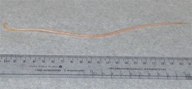 Asymptomatic Girl Who Passes Threadlike Object in Stool