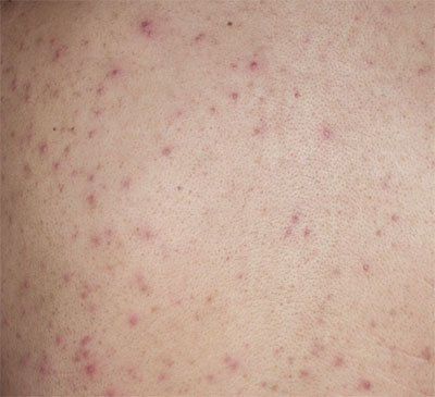 Pityrosporum Folliculitis | Contemporary Pediatrics