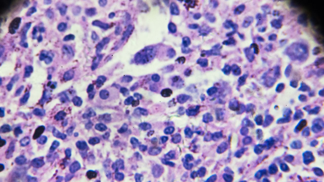 Epkinly Improves Progression-Free Survival in Relapsed/Refractory DLBCL ...