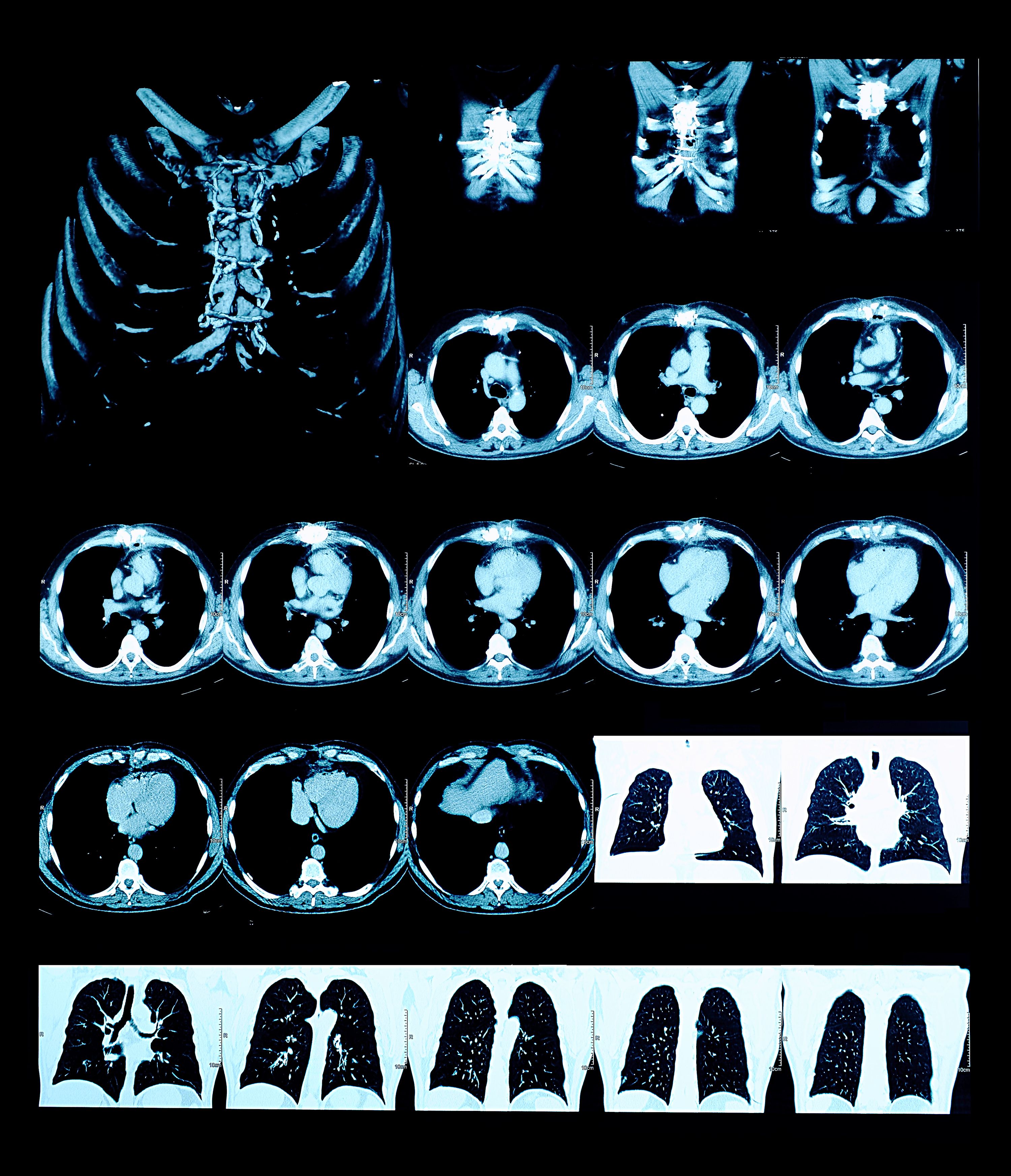 Certain Colorectal Cancer Survivors Should Be Closely Monitored for ...