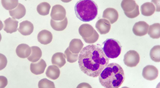 When and How CLL, SLL Should Be Treated | CURE