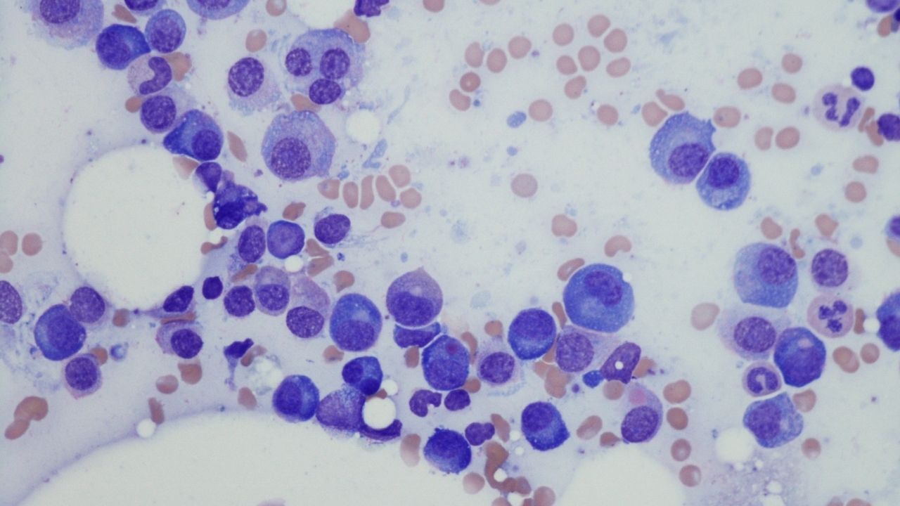 Tecvayli Associated With Reduced Risk of Myeloma Progression or Death ...