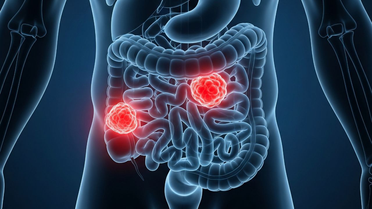 FDA Fully Approves Braftovi Combo for BRAF V600E Metastatic Colorectal ...