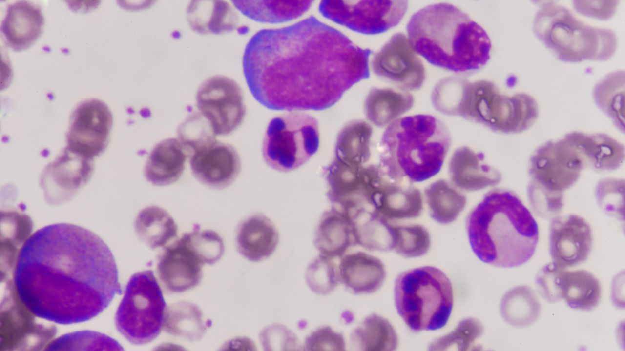 A Patient Guide to Understanding Stage 2 Chronic Myeloid Leukemia | CURE
