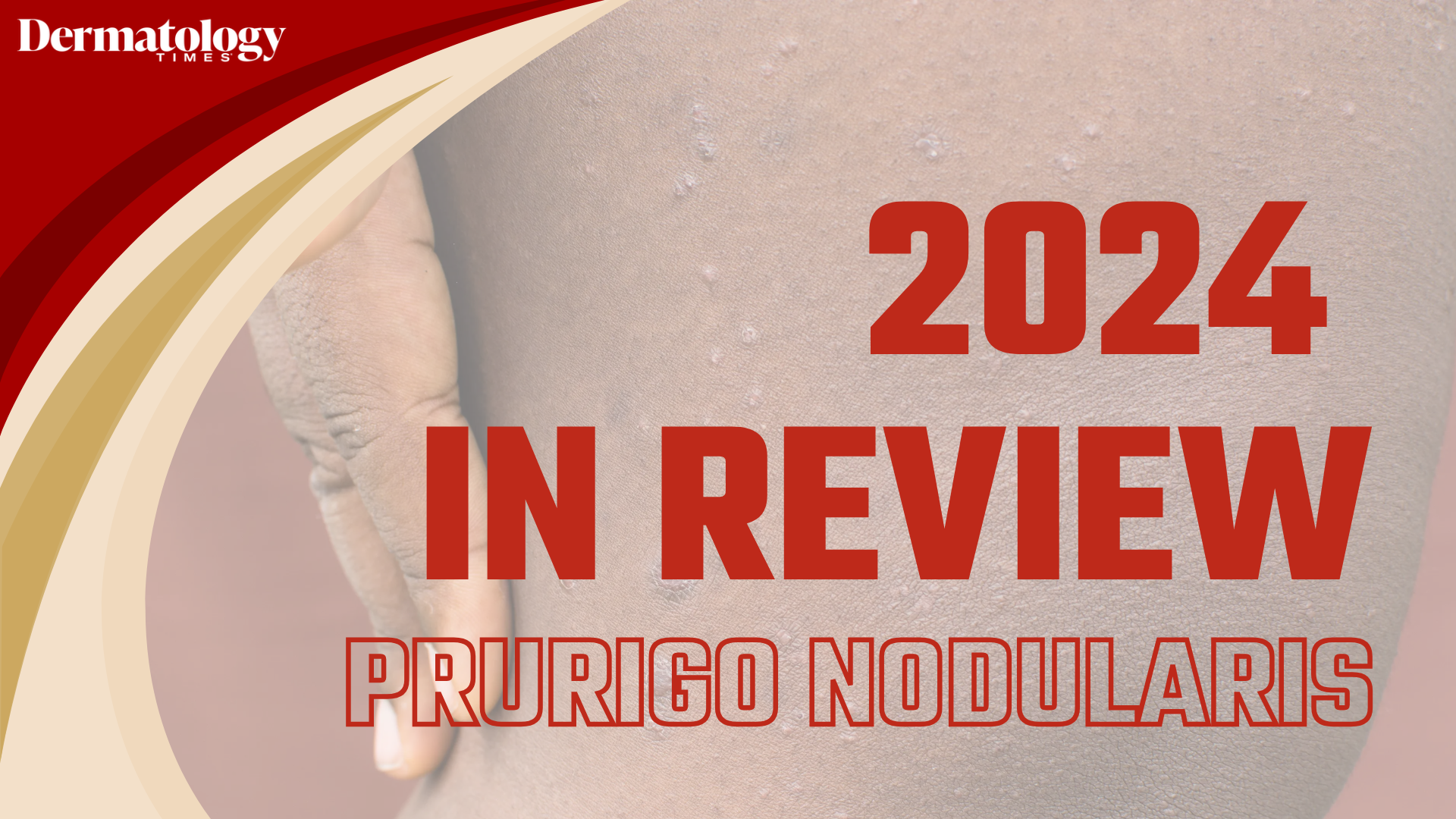 Dermatology Times 2024 In Review: Prurigo Nodularis | Dermatology Times