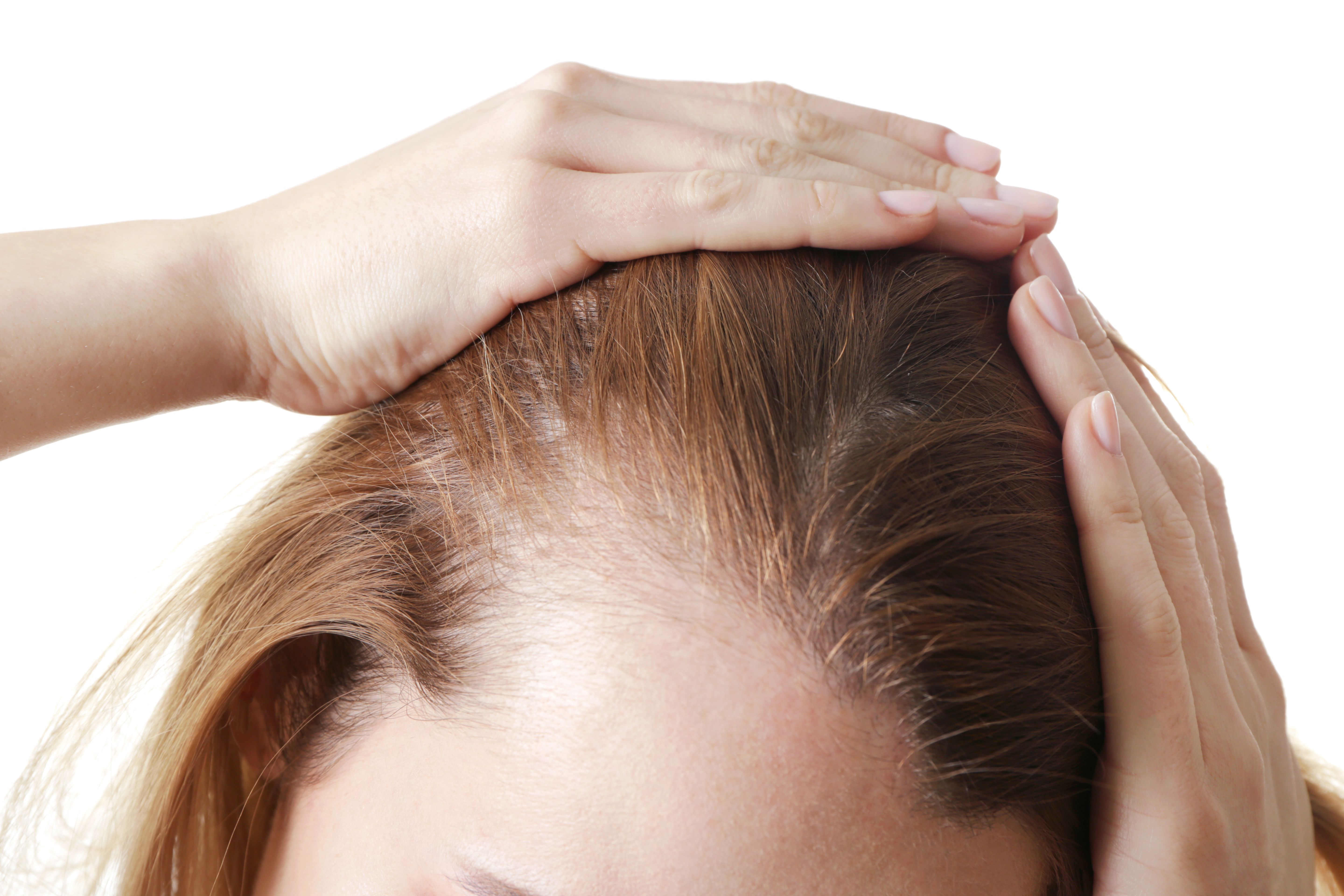AI Analysis Reveals Menopausal Hair Loss Linked to Systemic Health and ...
