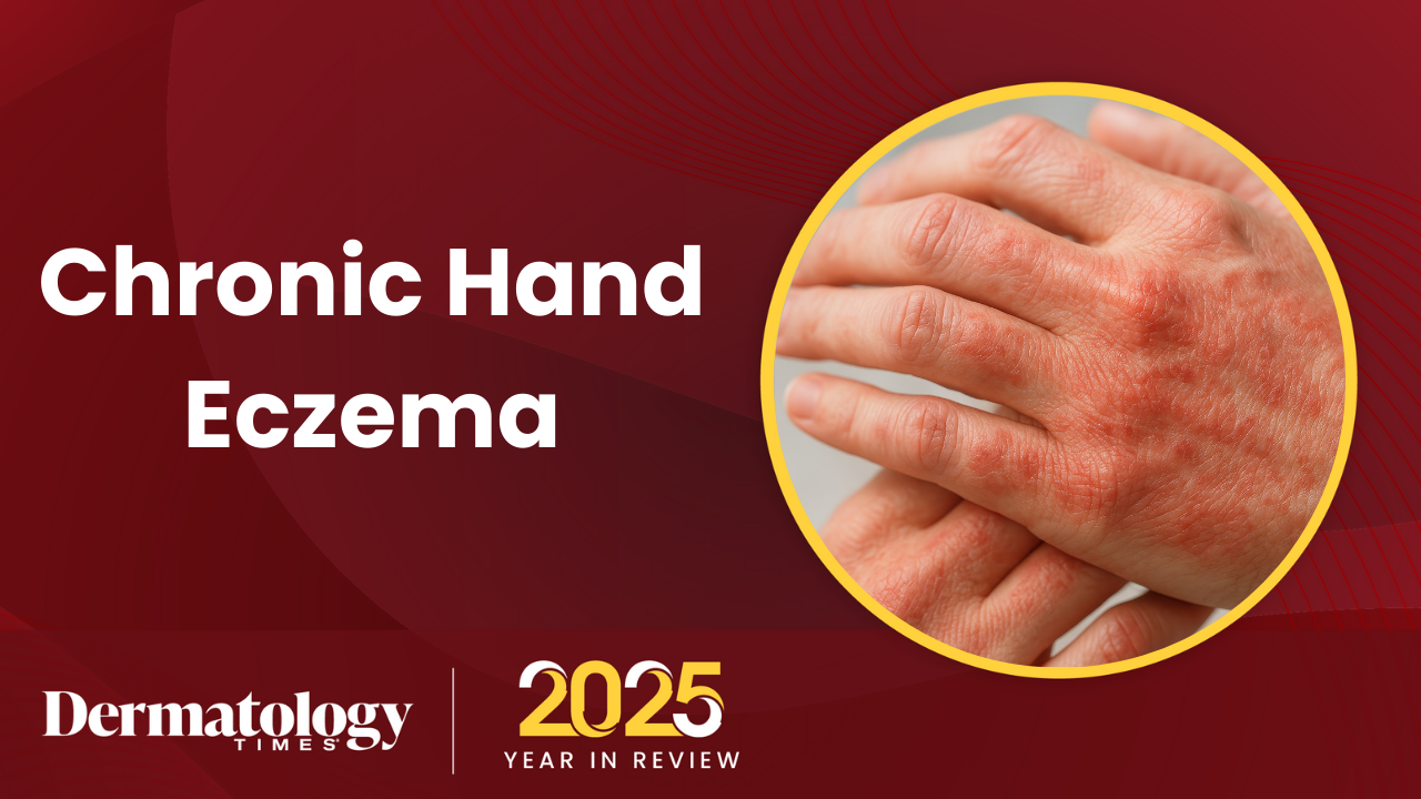 Dermatology Times 2025 Year in Review: Chronic Hand Eczema ...
