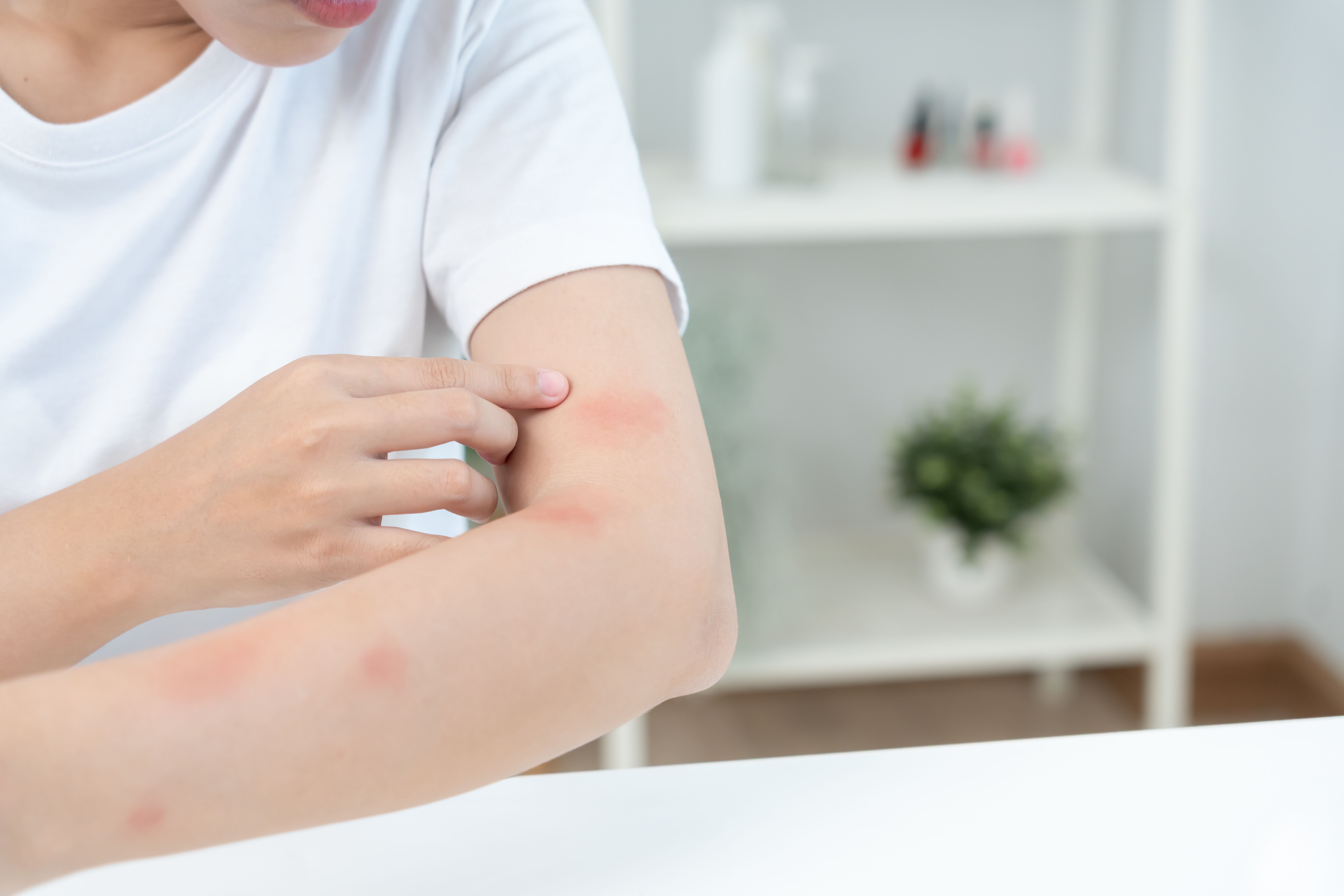 Expert Consensus Redefines the Role of Systemic Corticosteroids in AD ...