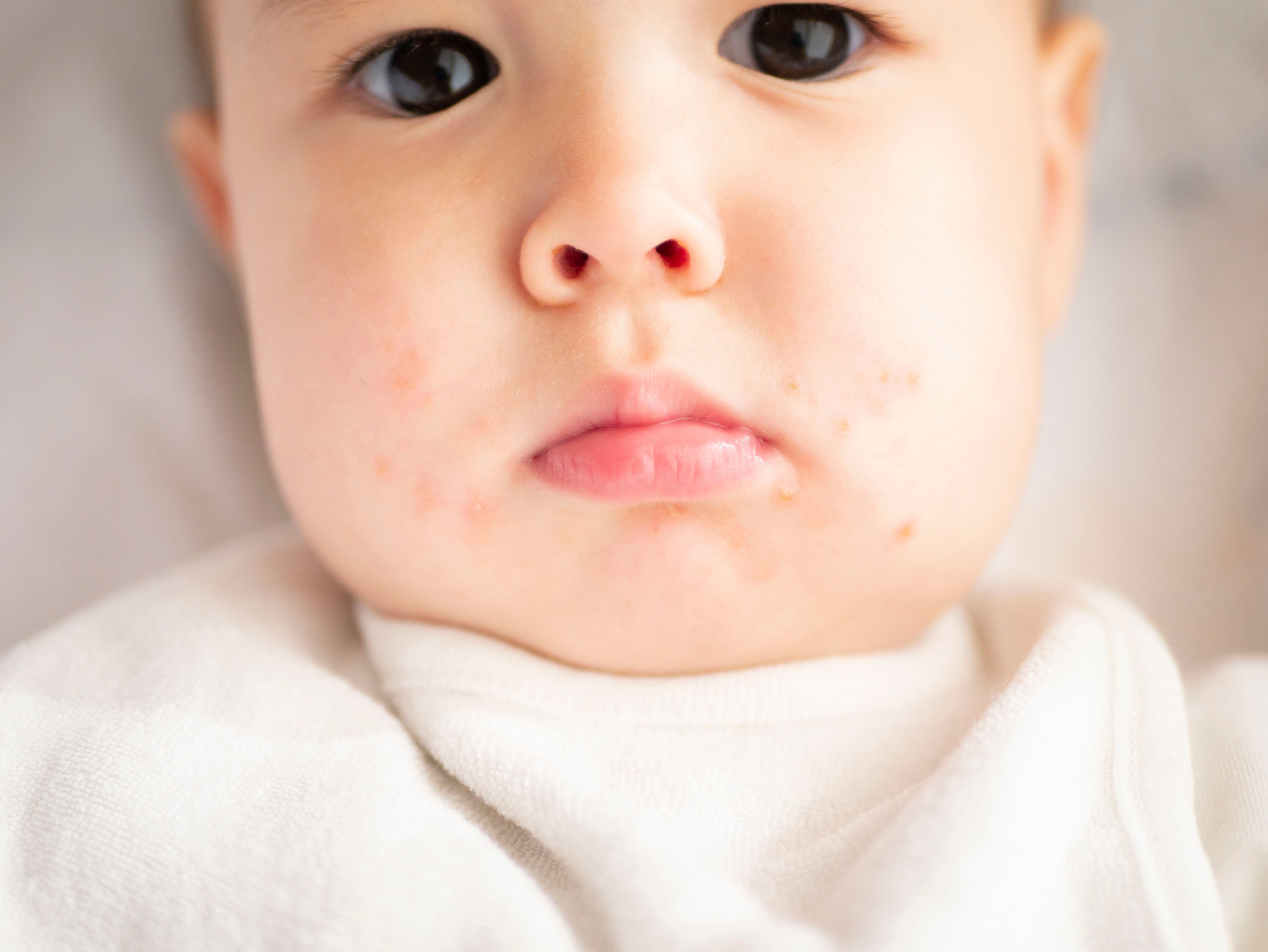 Pediatric Dermatology Update 2022 s Top Studies pediatric-dermatology-update-2022-s-top-studies