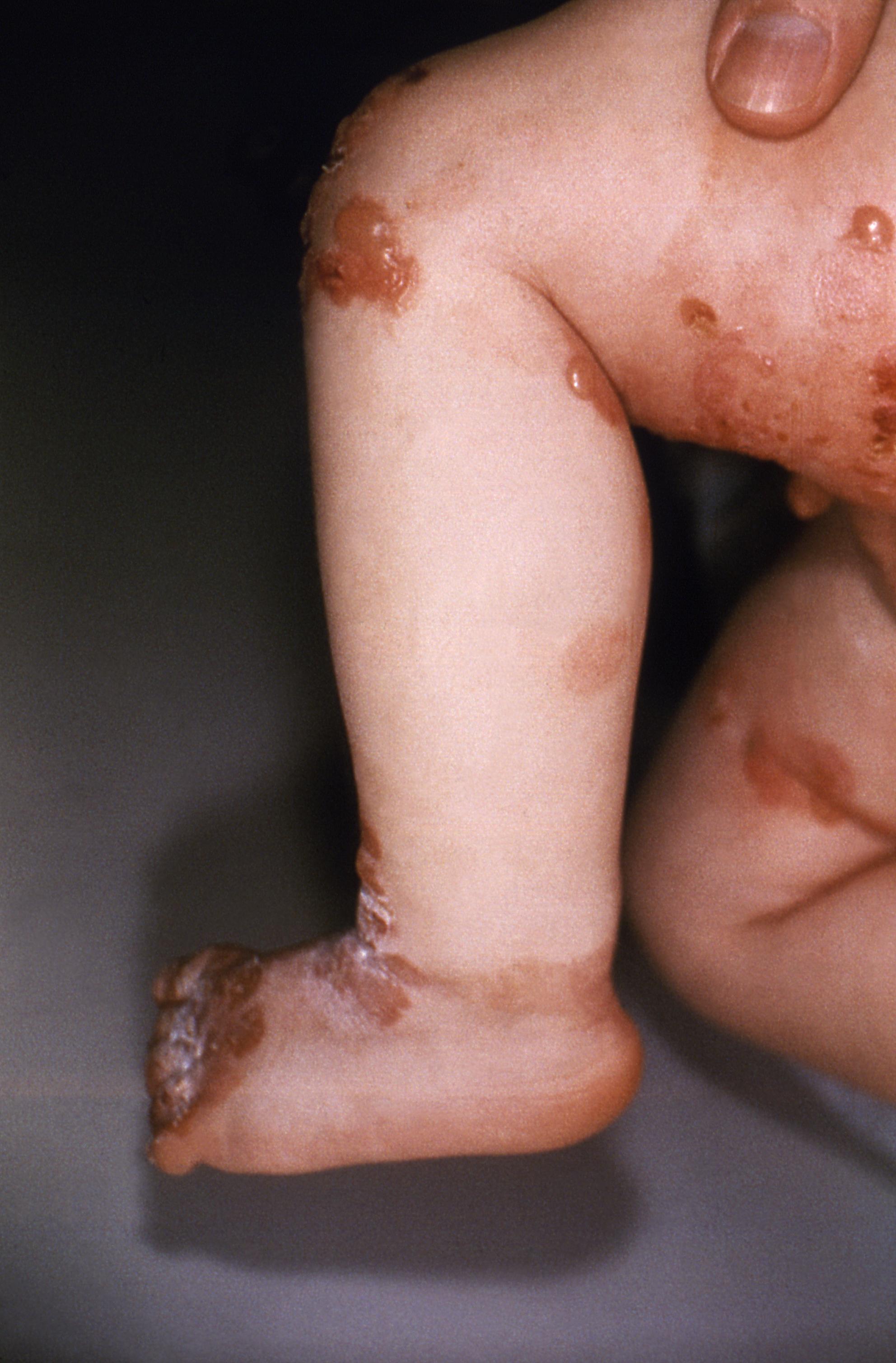 Oleogel-S10 for Epidermolysis Bullosa Wounds Demonstrated Accelerated ...