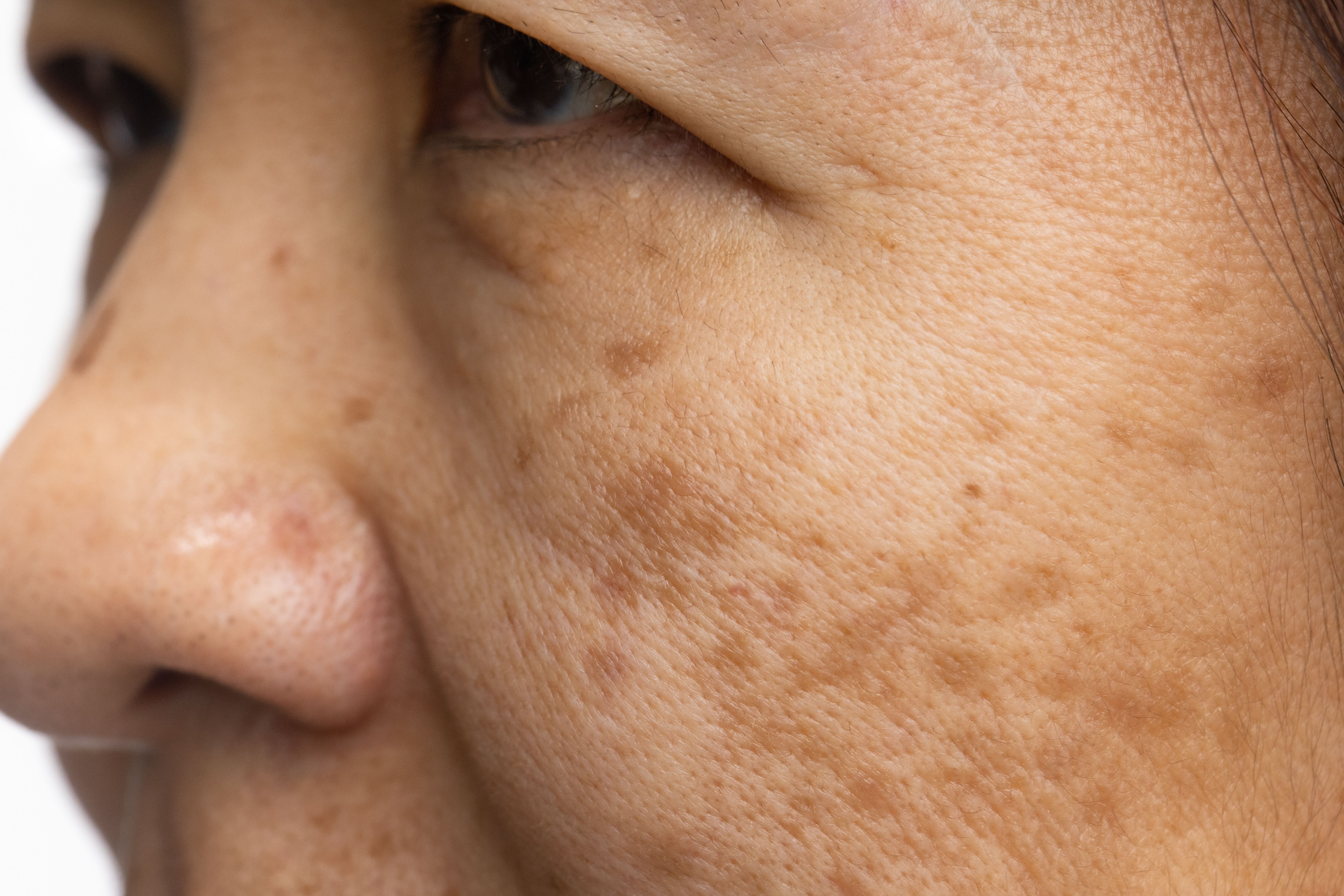 Combining Microneedling and Tranexamic Acid for Melasma: Efficacy and ...