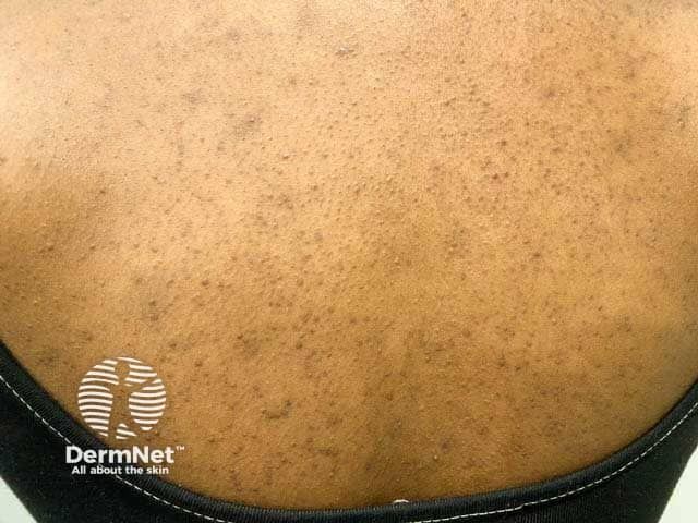 Trifarotene Cream is Effective for Acne-Induced PIH in Patients with ...