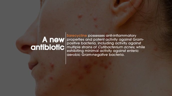 Top 5 stories on antibiotics and acne