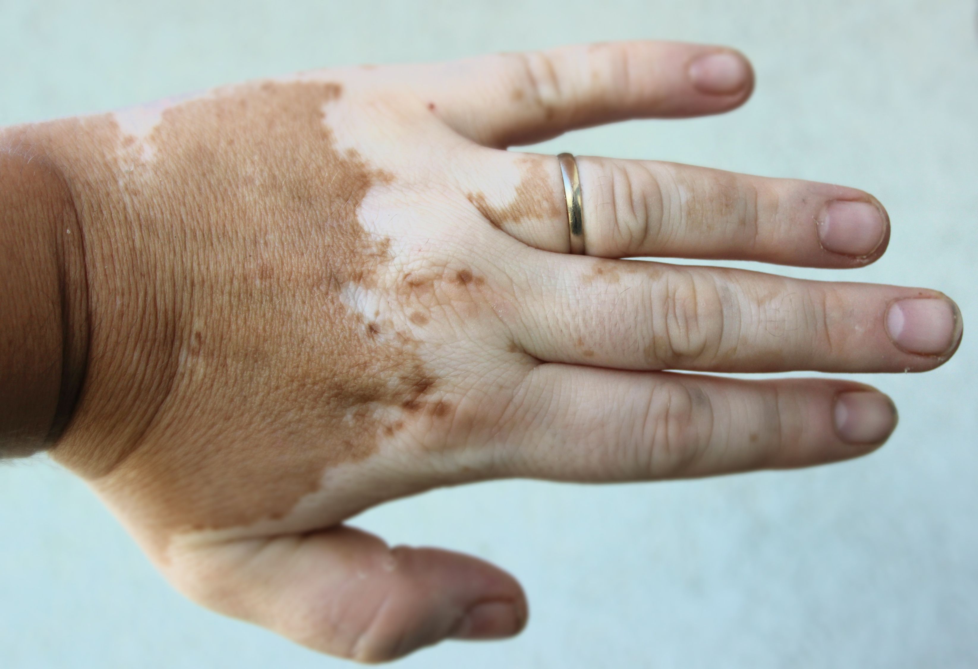 Surgical Treatment of Vitiligo