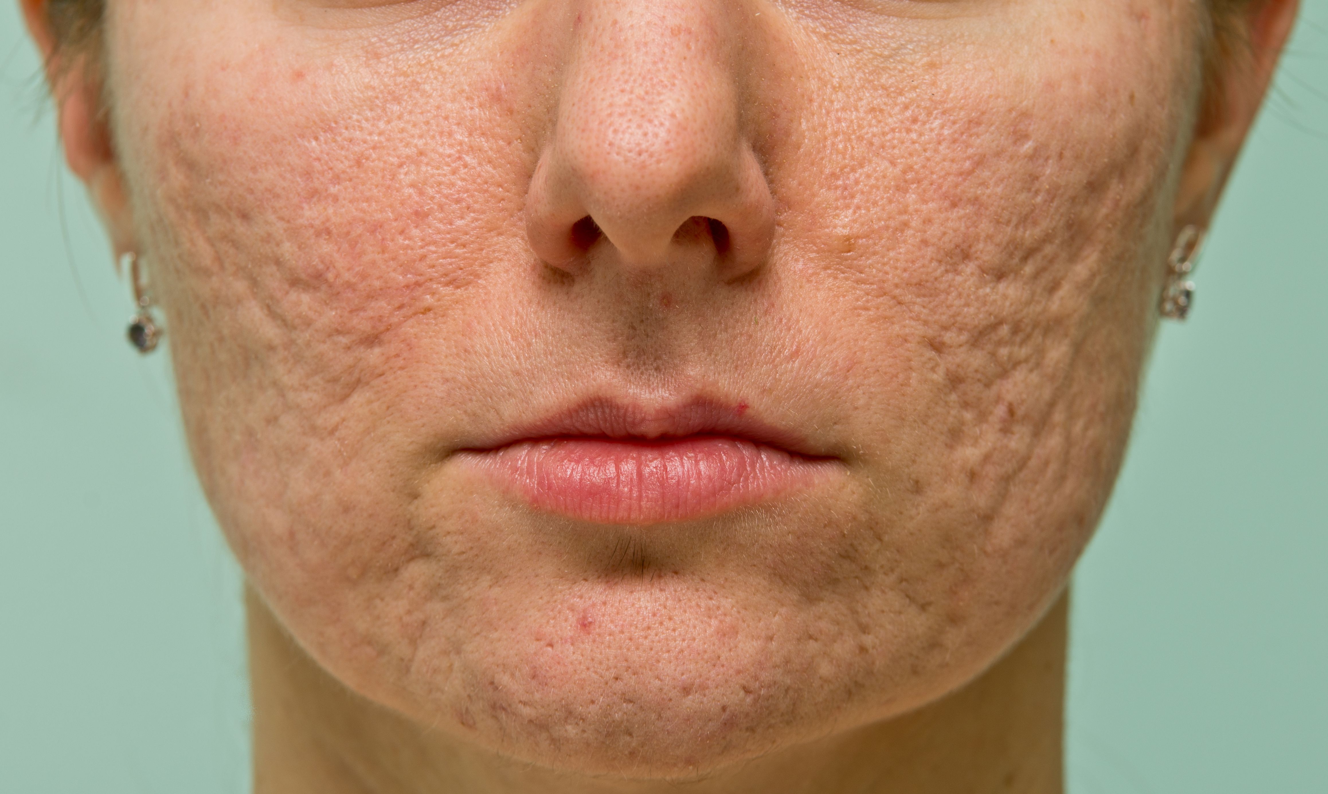 FDA Clears Sofwave SUPERB Applicator for the Treatment of Acne Scars ...