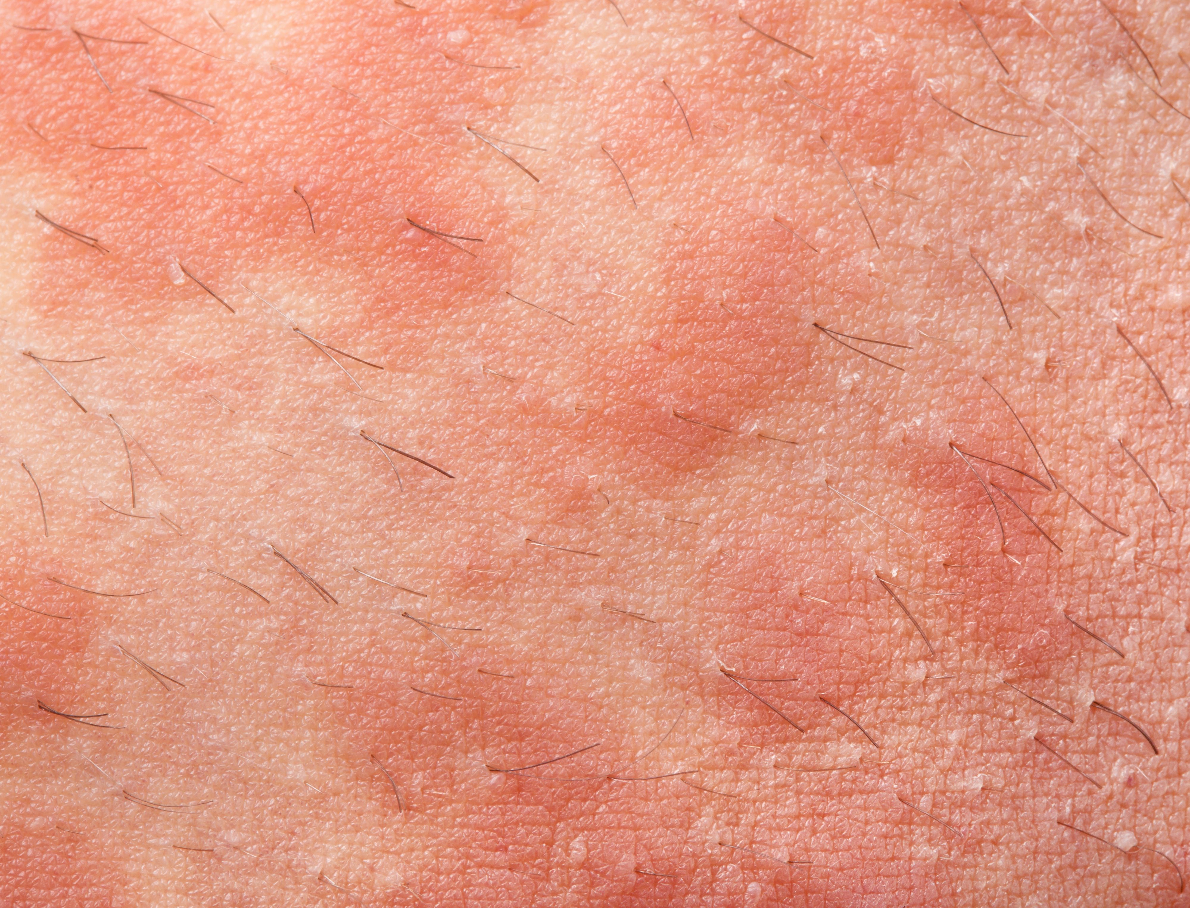Upadacitinib Approved in EU for Atopic Dermatitis
