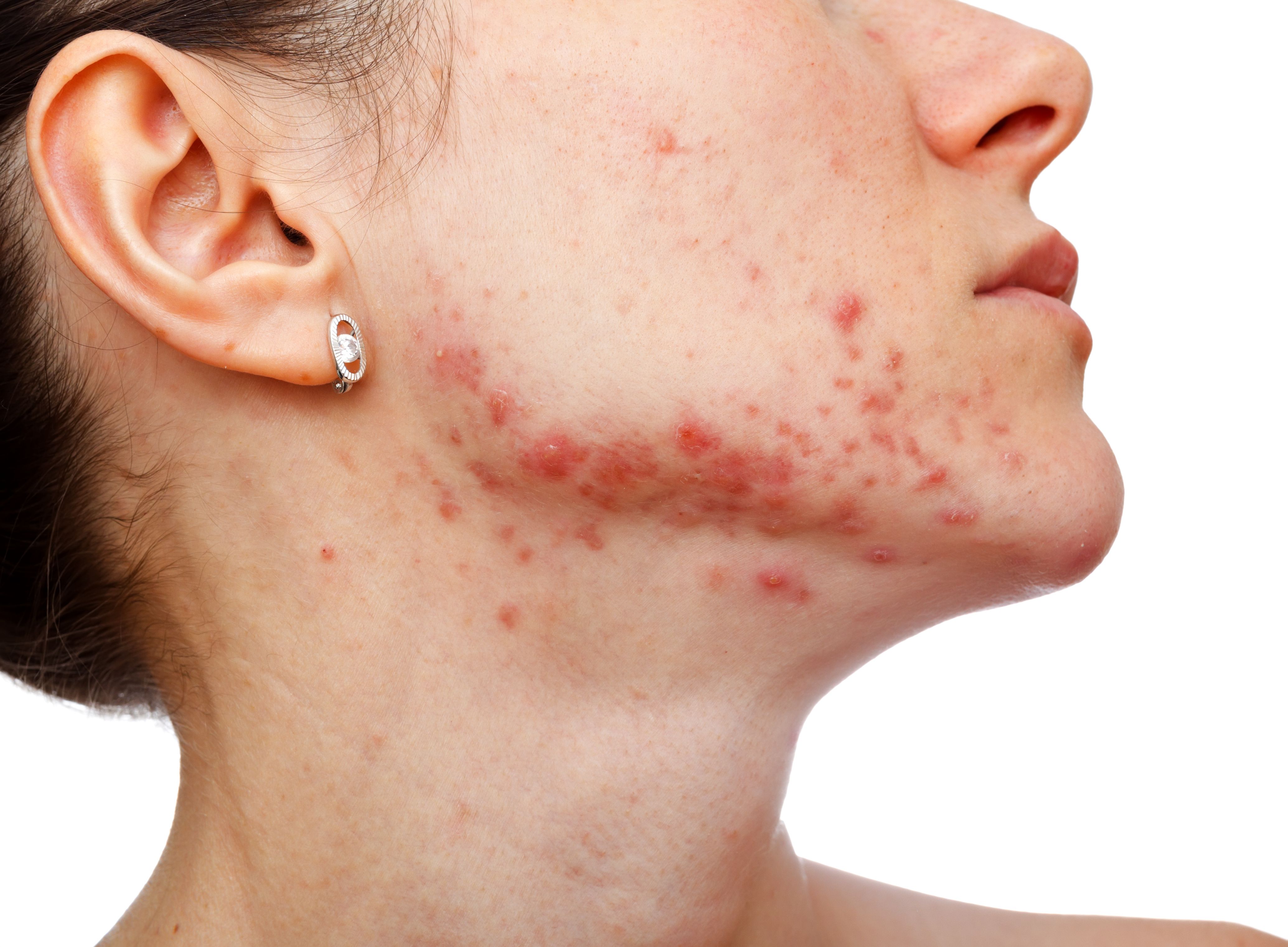 Beyond Isotretinoin: New Review Explores the Evolving Landscape of ...
