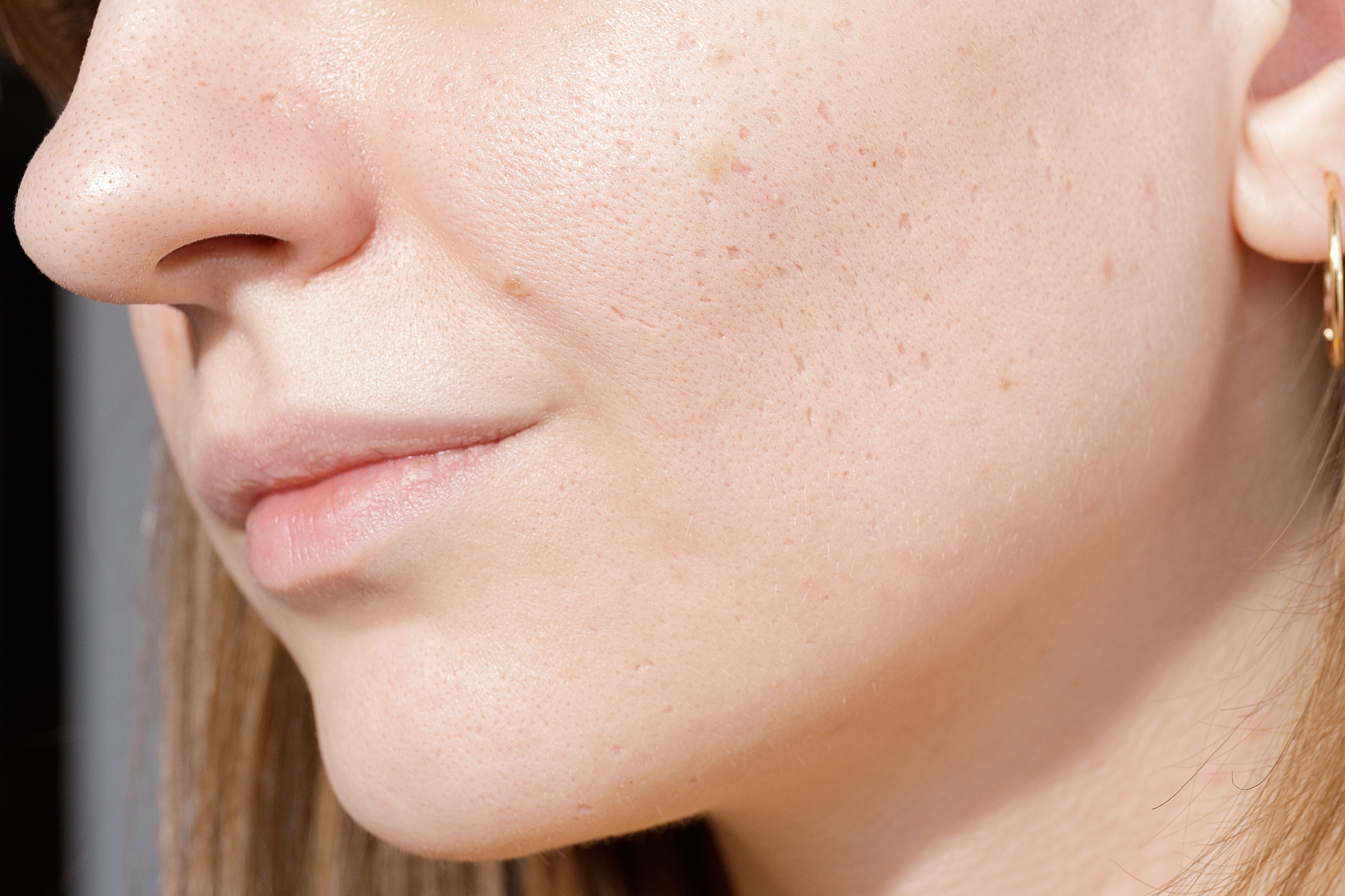 Fractional Picosecond Laser is an Effective Treatment For Atrophic Acne ...