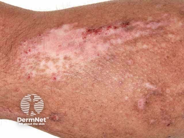 Matching the Molecule to the Patient: Using a 487-GEP Test to Guide AD ...