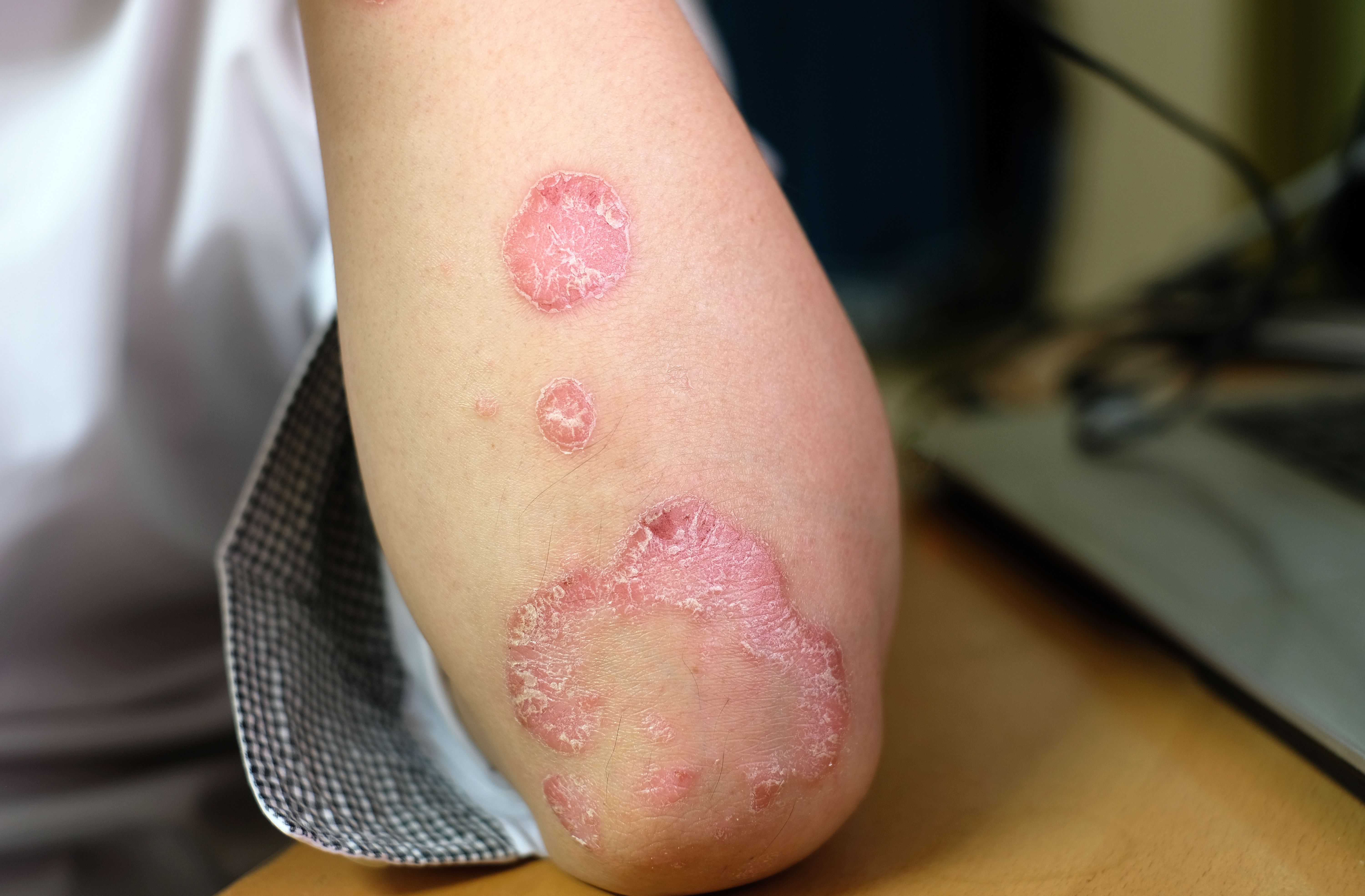 Artax Presents Phase 2a Results of AX-158 for Plaque Psoriasis ...