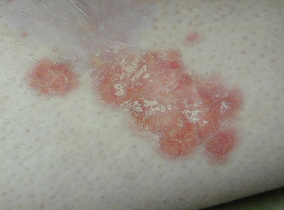 A Close Look at Necrobiosis Lipoidica | Dermatology Times