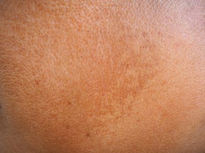 Dermoscopy serves dual role in melasma management | Dermatology Times ...