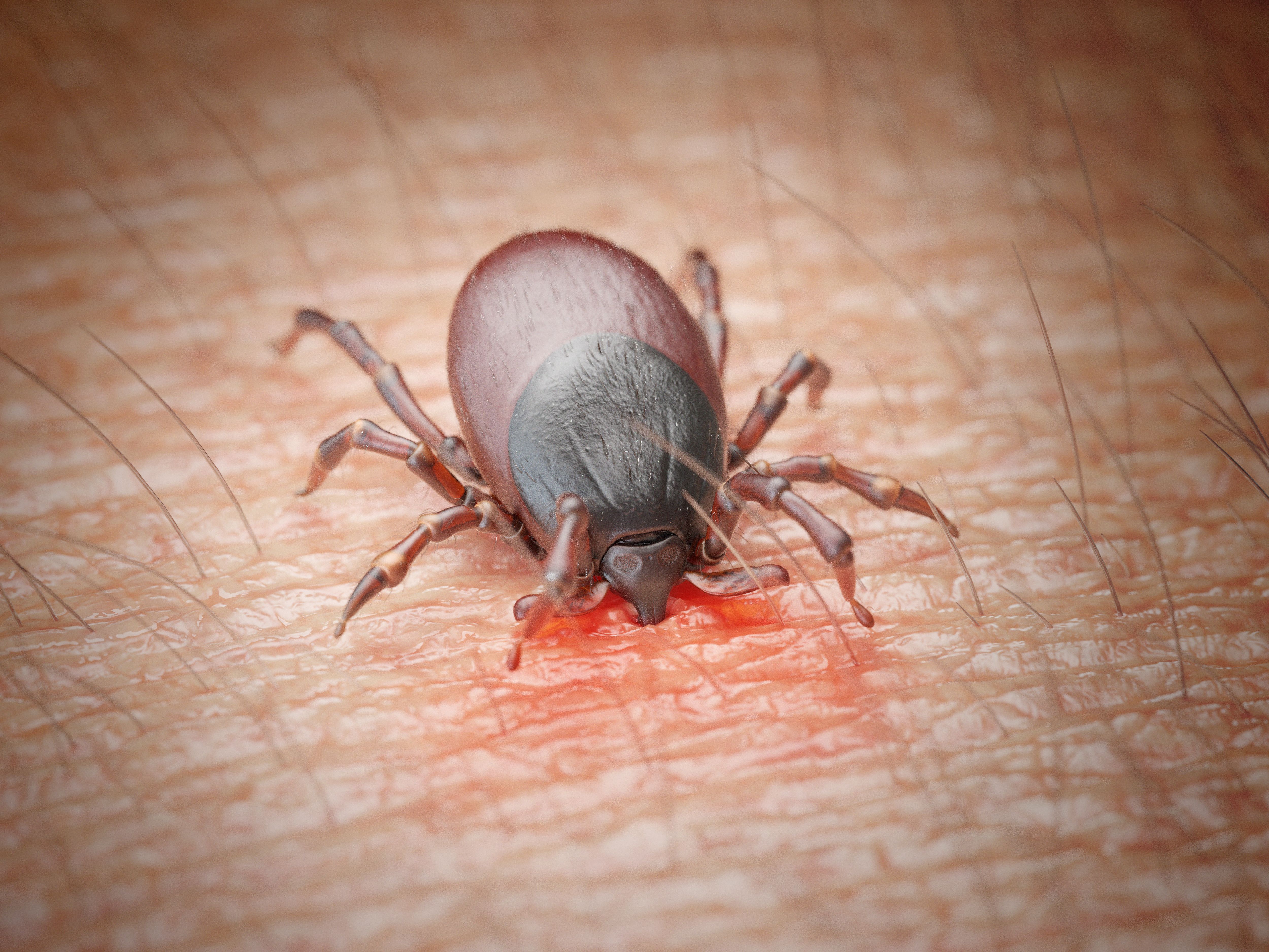 Disseminated Erythema Migrans as a Result of Lyme Disease | Dermatology ...