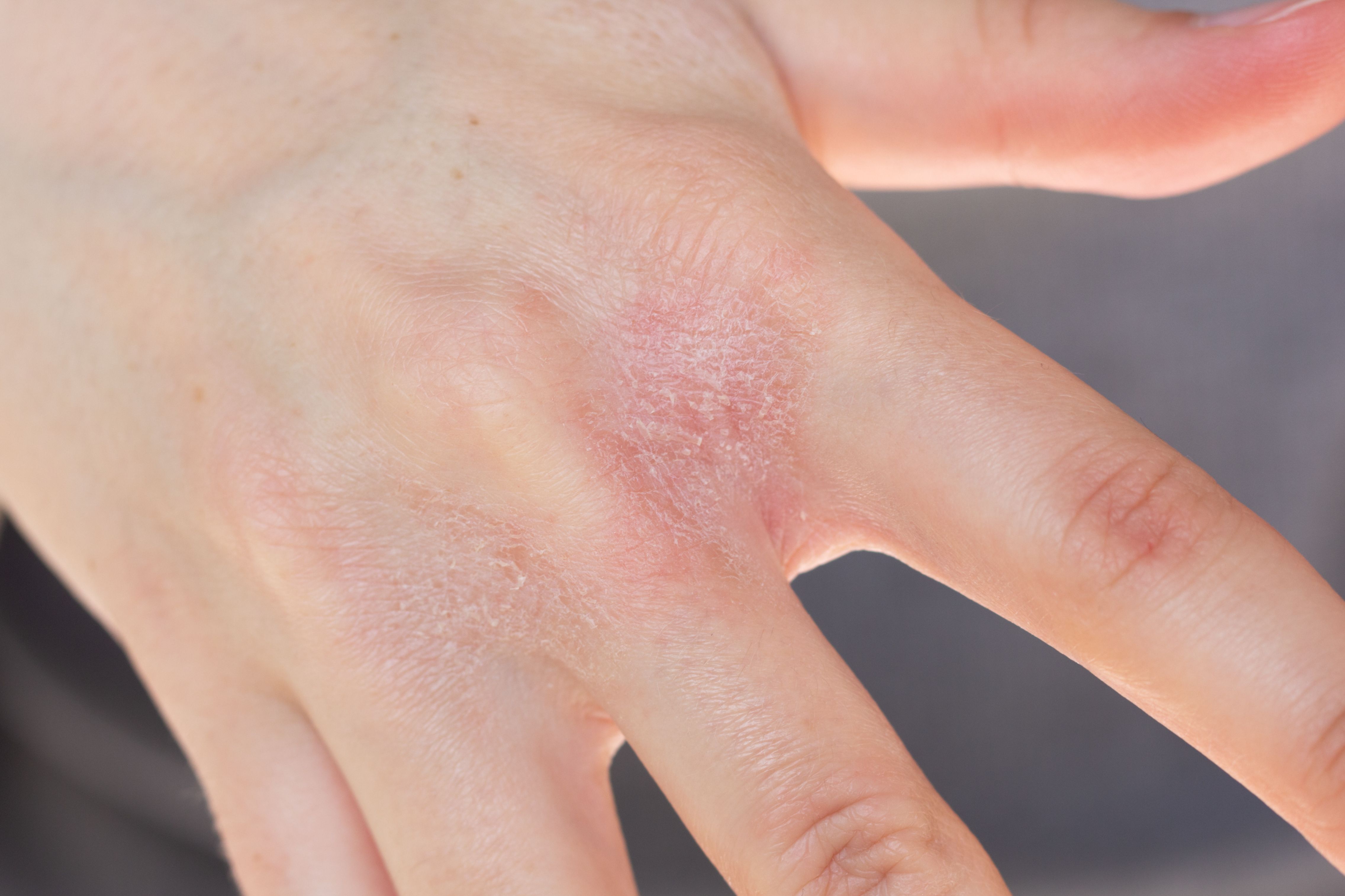 Increased Use of L23.8 Code in Allergic Contact Dermatitis Highlights ... Increased Use of L23.8 Code in Allergic Contact Dermatitis Highlights ...