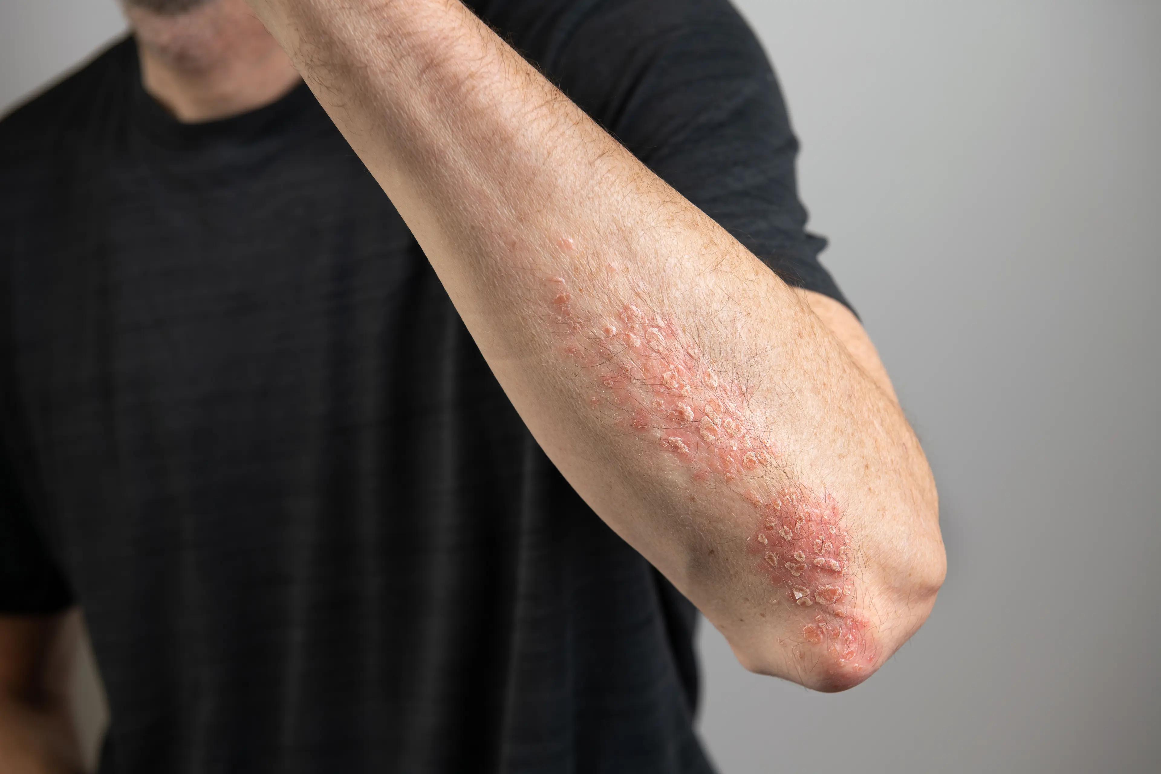 Oral IL-23 Blocker Shows Durable Psoriasis Control at 1 Year ...