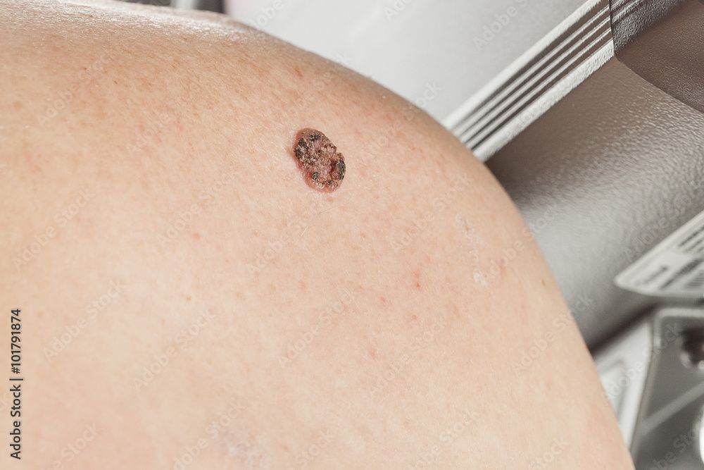 FDA Clears DermaSensor Device for Skin Cancer Detection | Dermatology ...