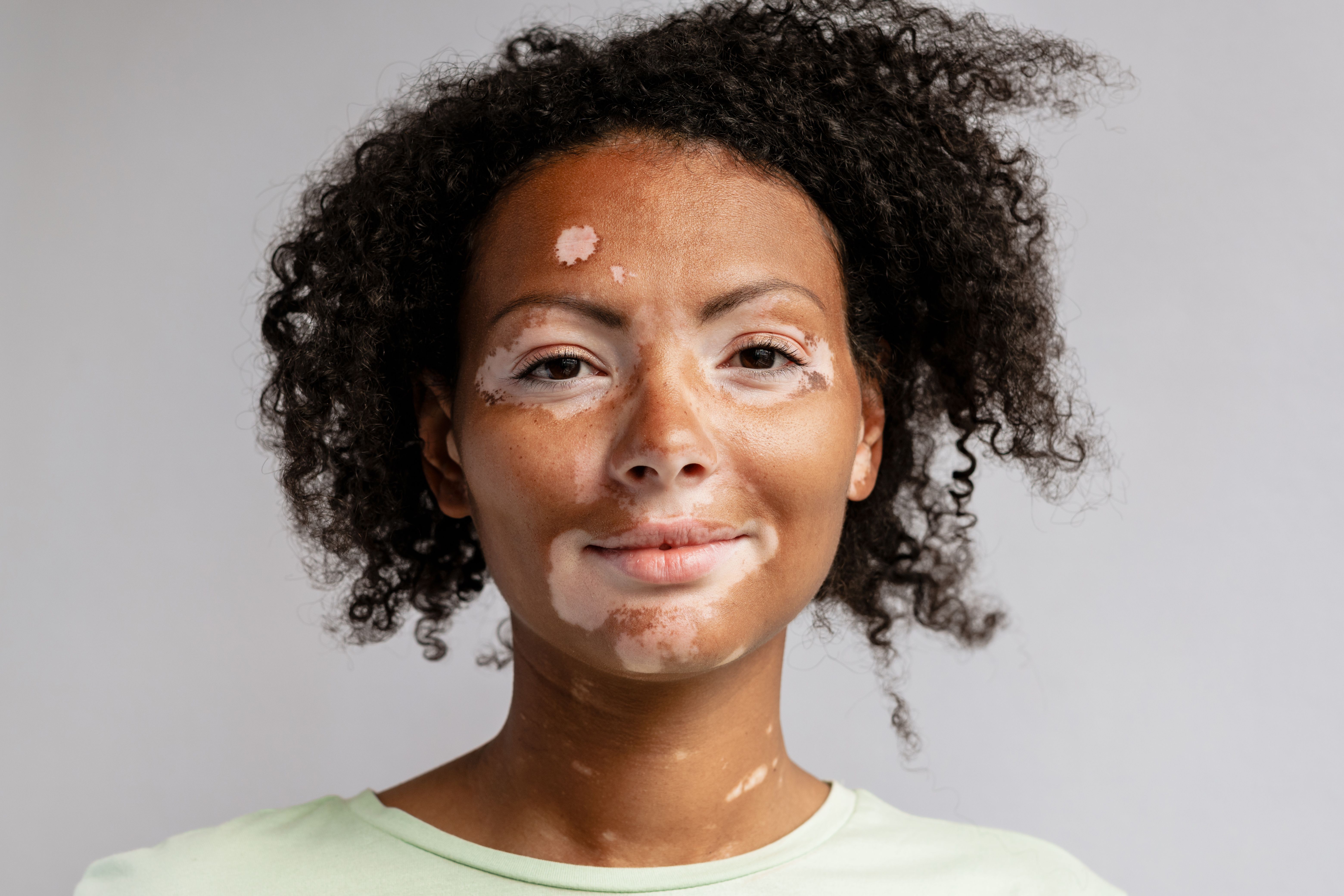 Diagnosing and Treating Different Pigmentation Disorders | Dermatology ...