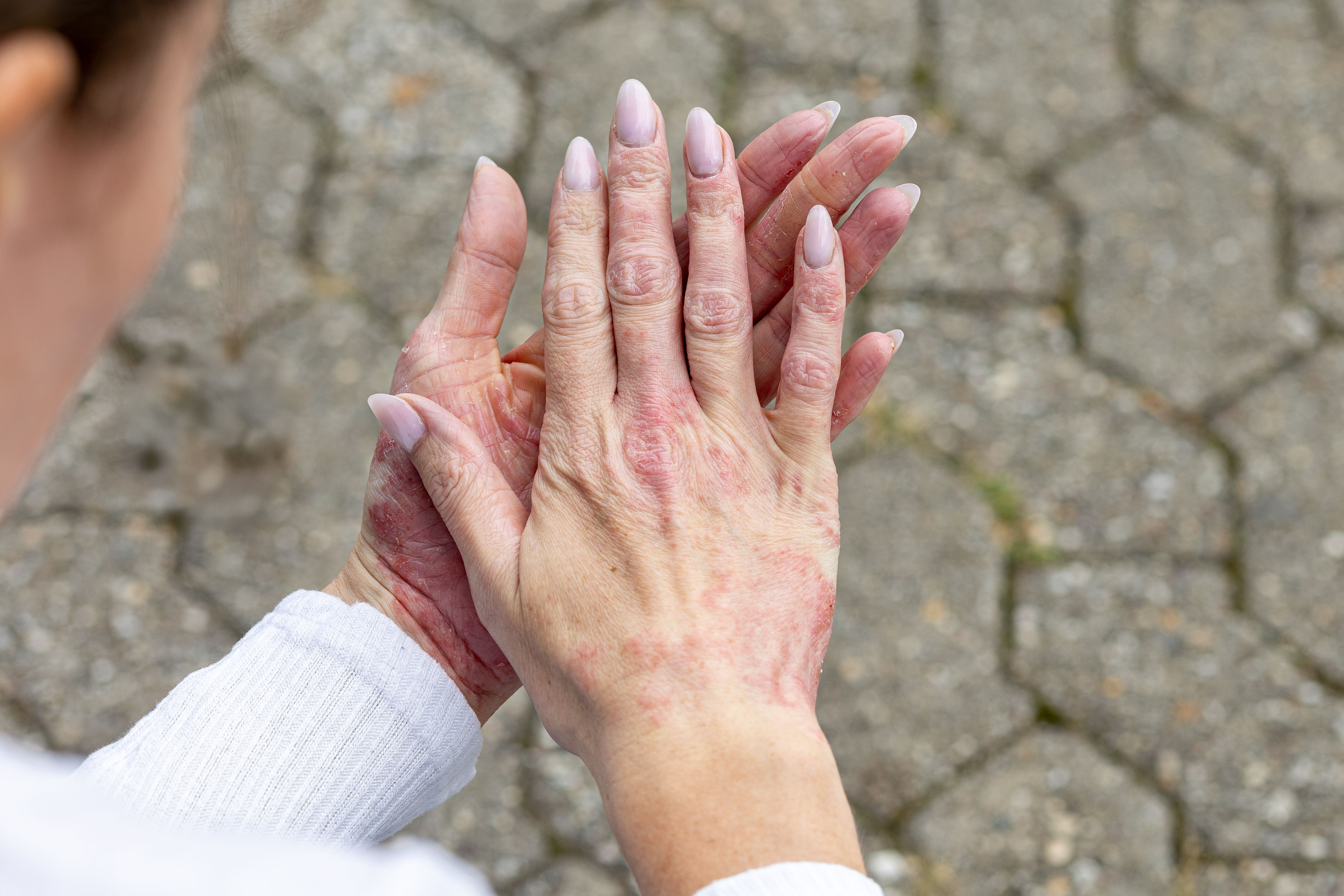 CHE Experts Provide Framework for Diagnosis, Management, and Care in ...