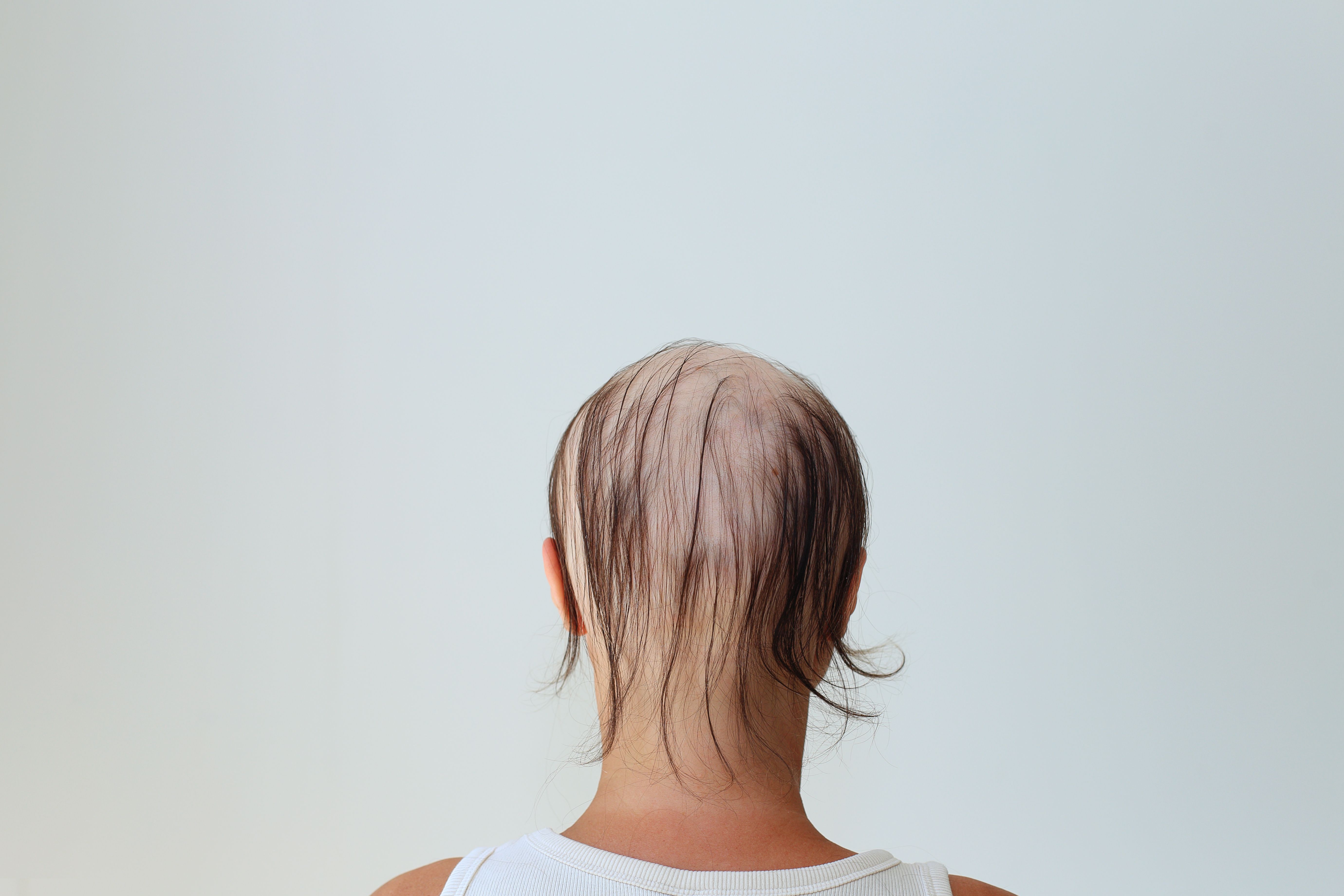 Q32 Bio’s Bempikibart Receives FDA Fast Track Designation for Alopecia ...