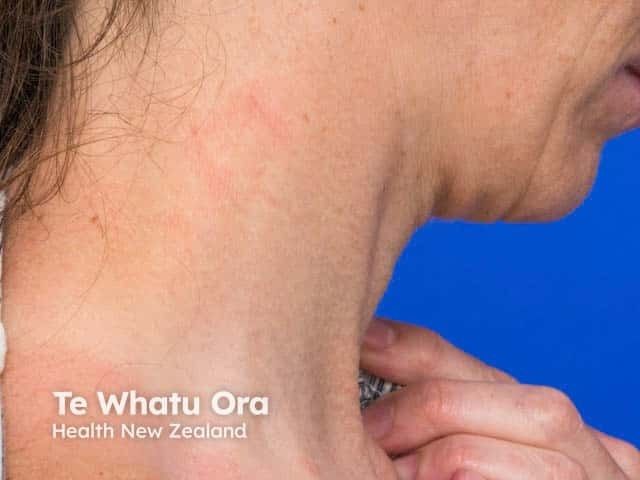 Galvokimig Achieves High EASI Scores in Pilot Study | Dermatology Times