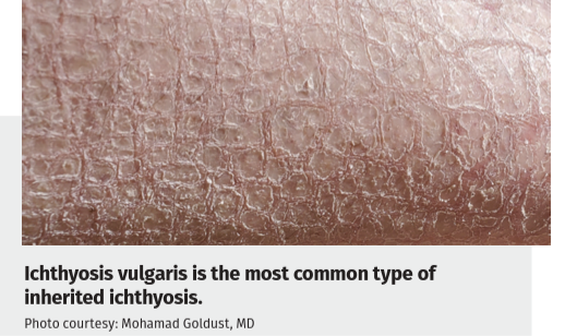 Current Research Reveals New Treatment Options for Ichthyosis ...