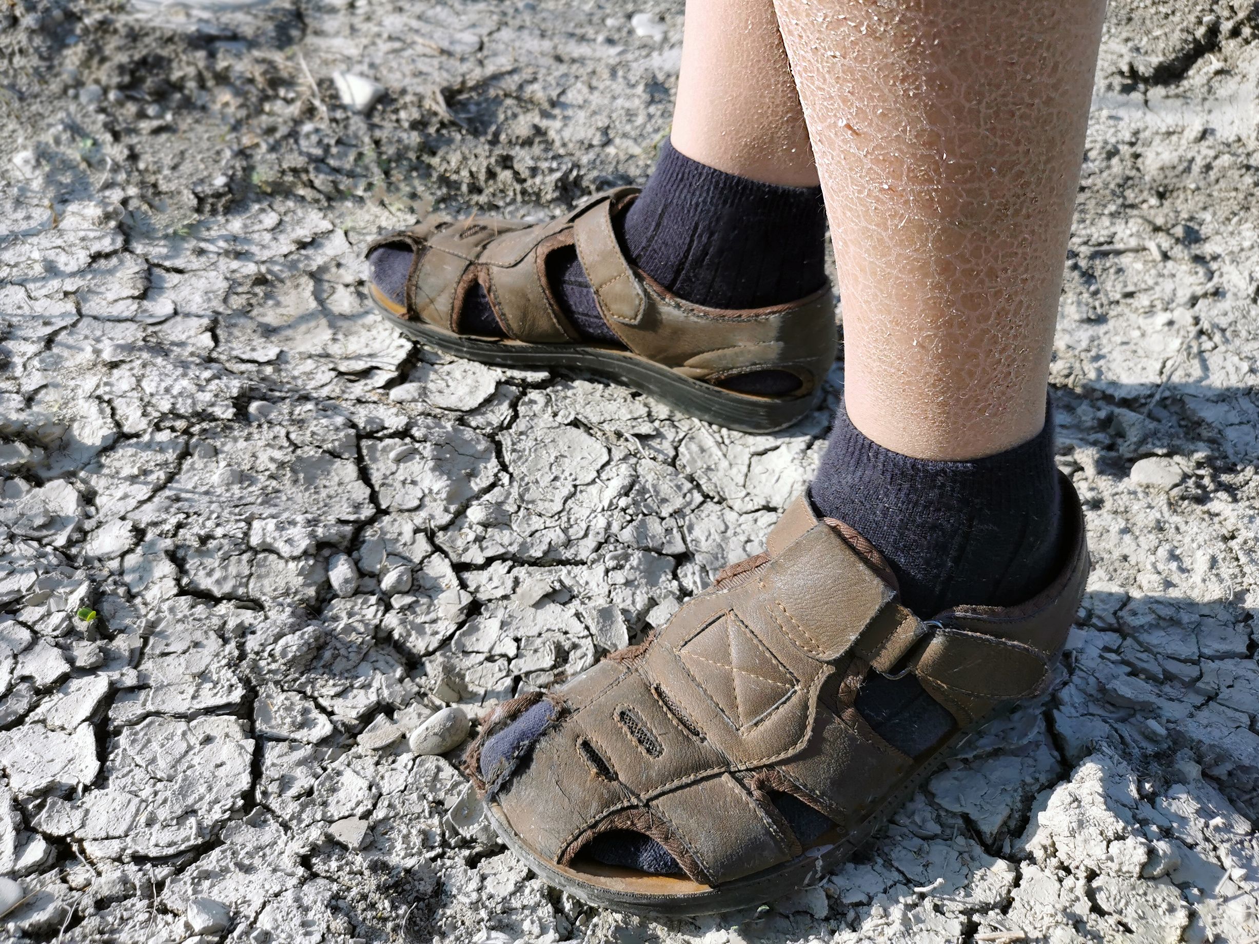 Unusual Cases from the Genodermatosis Clinic in London | Dermatology Times