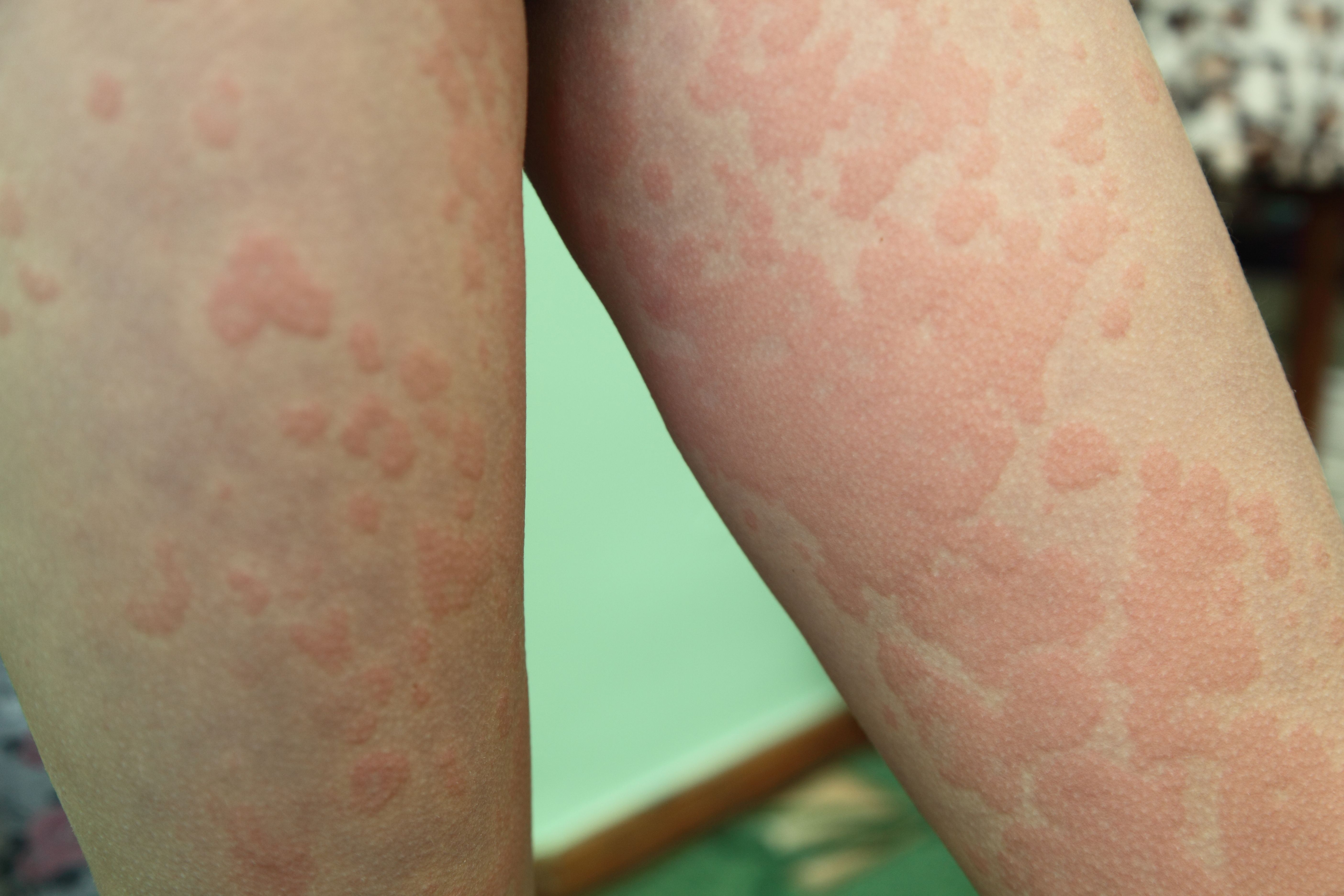 Japan Approves Dupilumab for Chronic Spontaneous Urticaria ...
