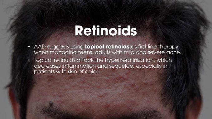 Acne treatment guidelines at a glance | Dermatology Times