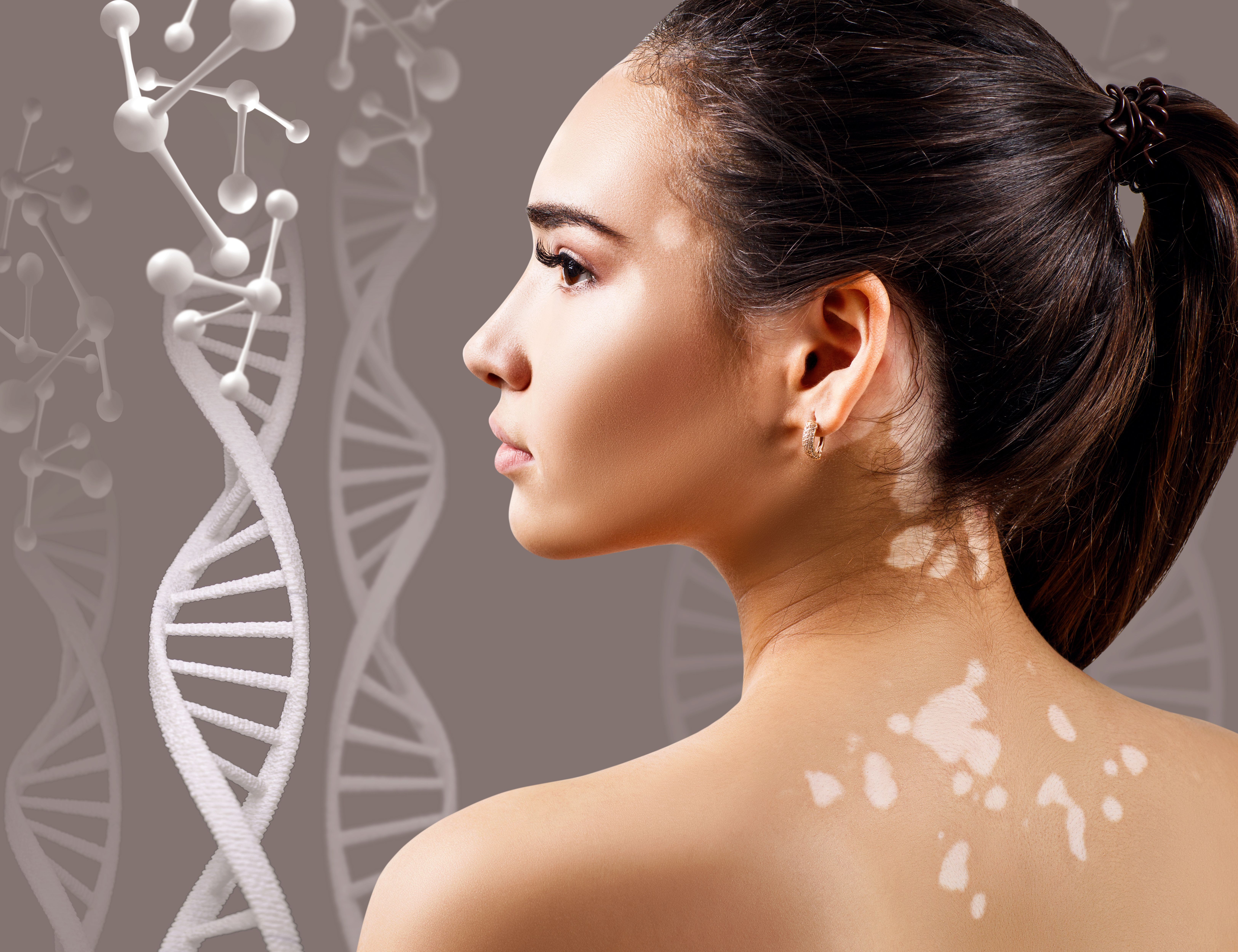 Trained Immunity May Play a Role in the Pathogenesis of Vitiligo ...